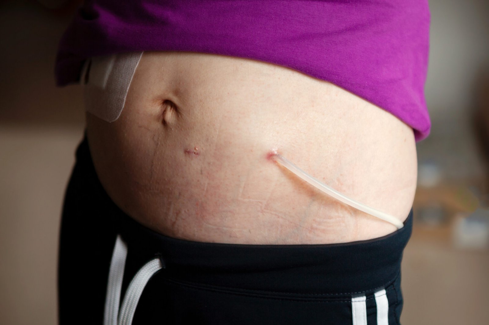 Peritoneal Dialysis - Dr. Rohit Badge | Kidney Healthcare Clinic | Nephrologist In Nagpur